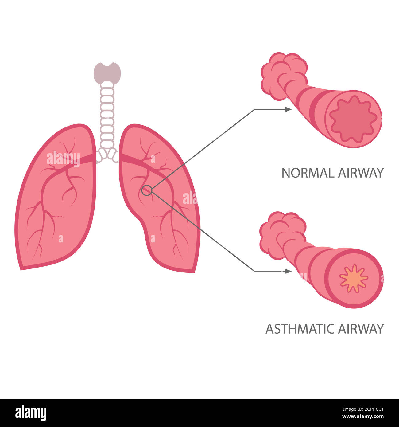 Asthma Attack Diagram