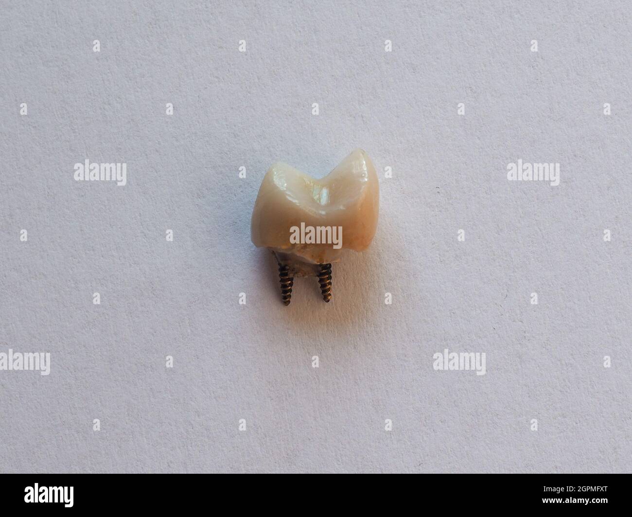 broken failed tooth with metal post and core filling and crown Stock ...