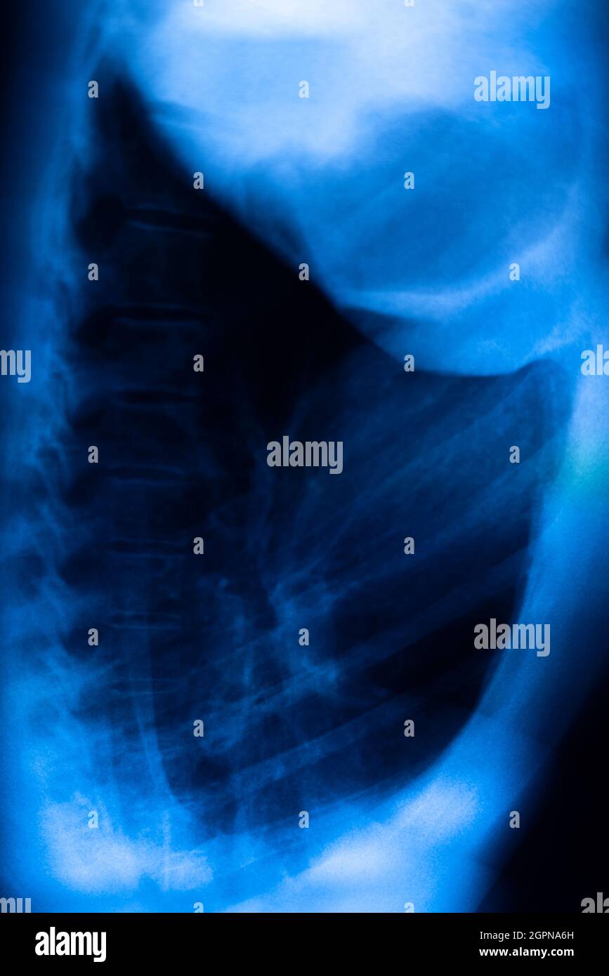 Lungs ribs x-ray scan test result Stock Photo - Alamy