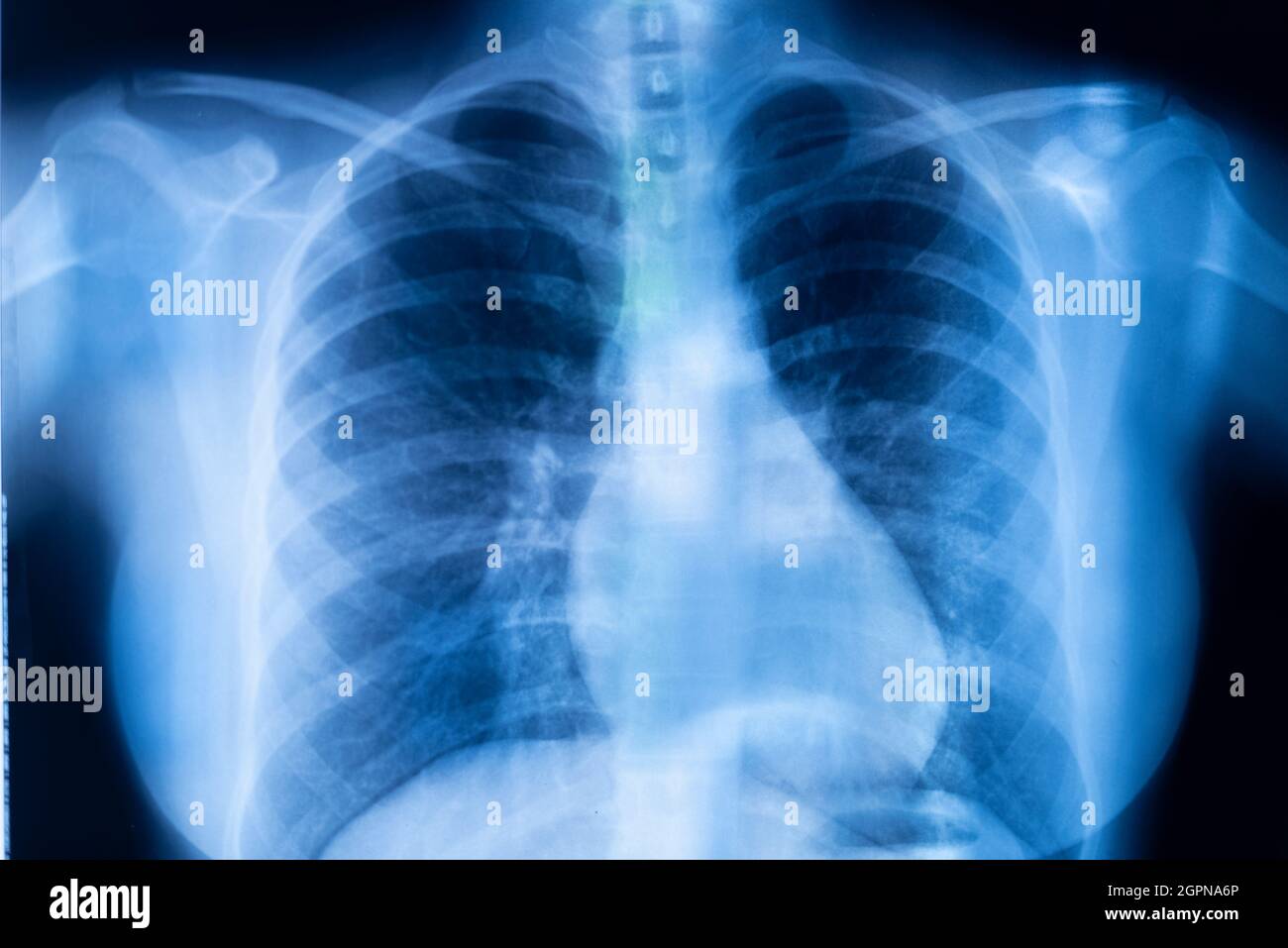 Lungs ribs x-ray scan test result Stock Photo - Alamy