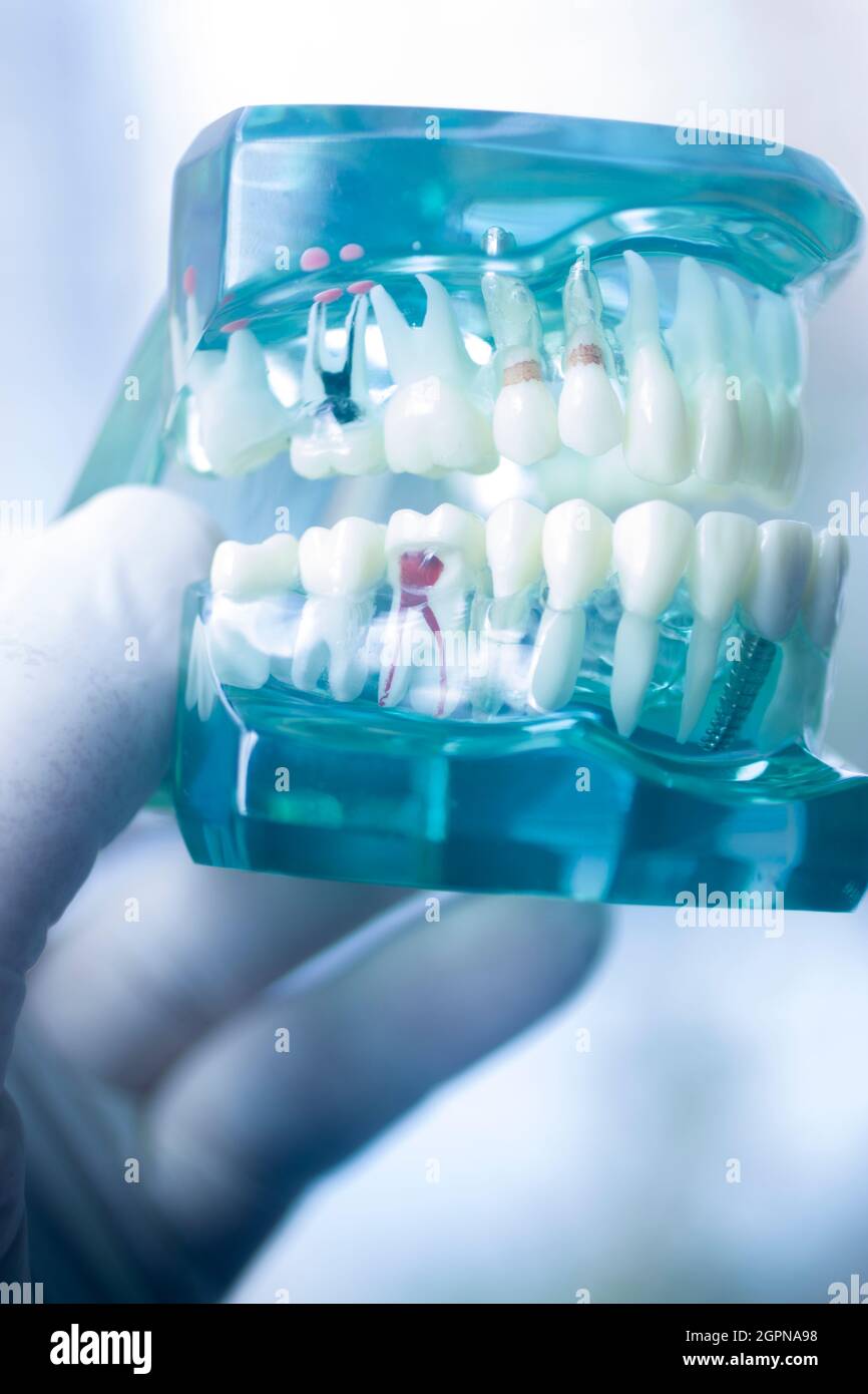 Teeth decay dentistry model showing caries in tooth Stock Photo - Alamy