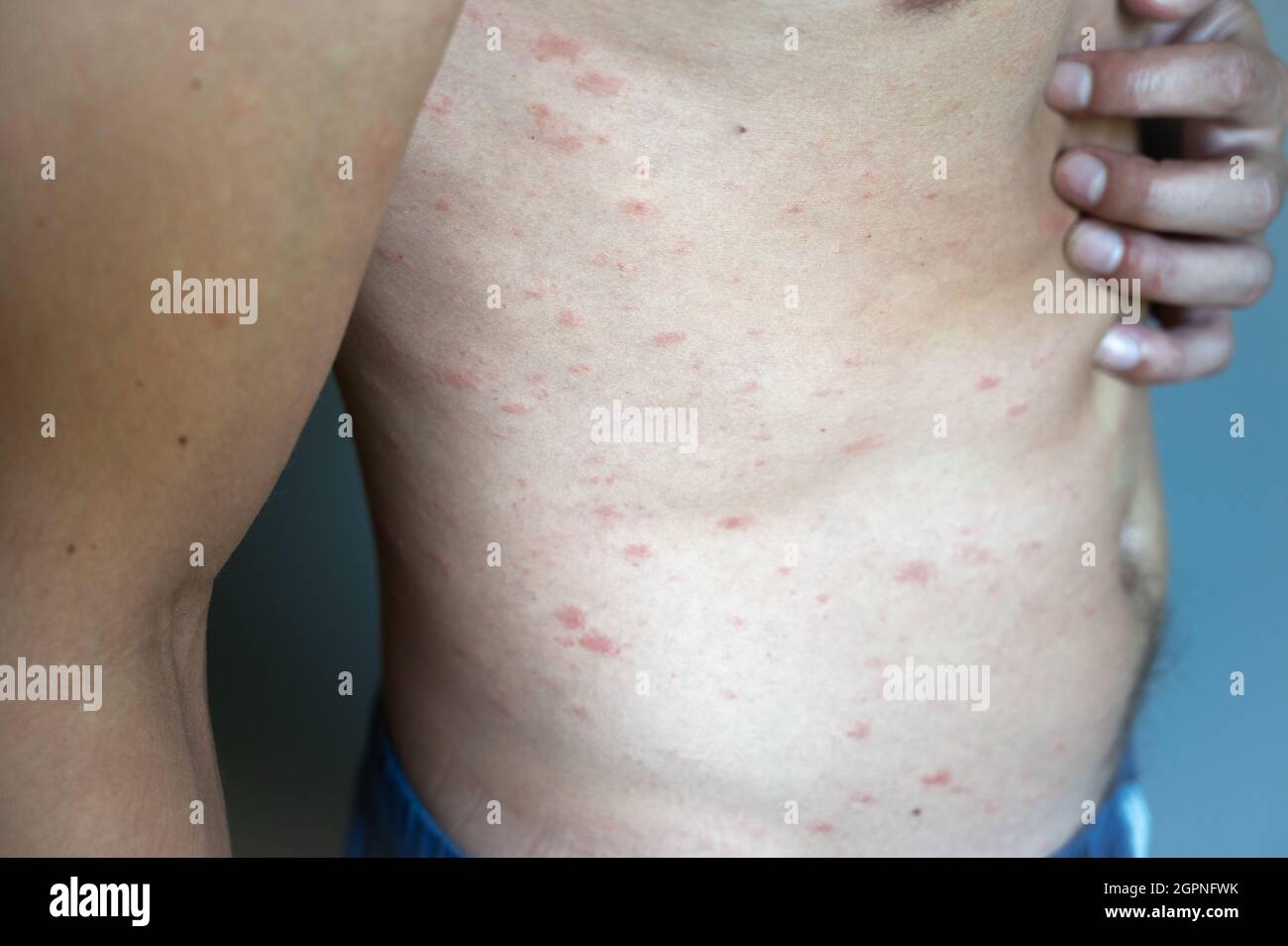 Atopic eczema allergy texture of ill human skin. Man with symptoms of ...