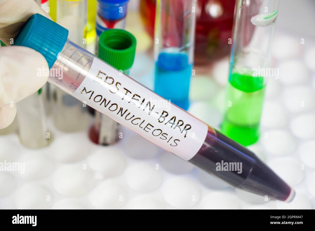 Mononucleosis blood High Resolution Stock Photography and Images - Alamy