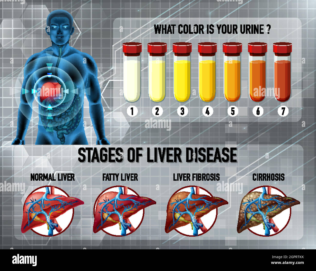 Stages of liver disease Stock Vector Image & Art - Alamy