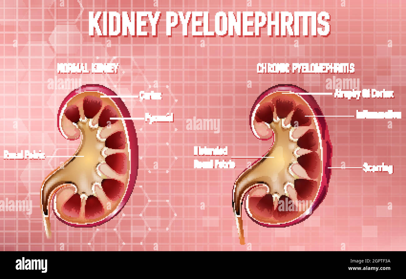 Informative illustration of Pyelonephritis Stock Vector Image & Art - Alamy