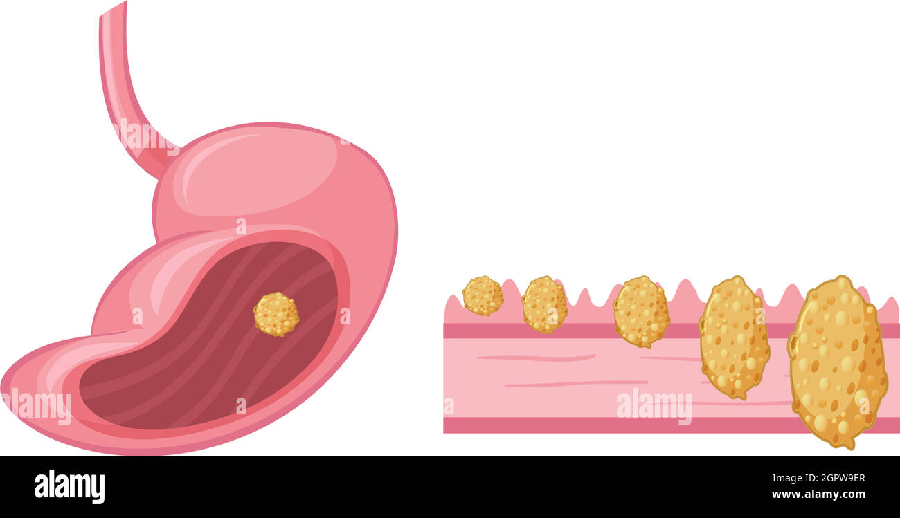 Cancer in human stomach Stock Vector Image & Art - Alamy