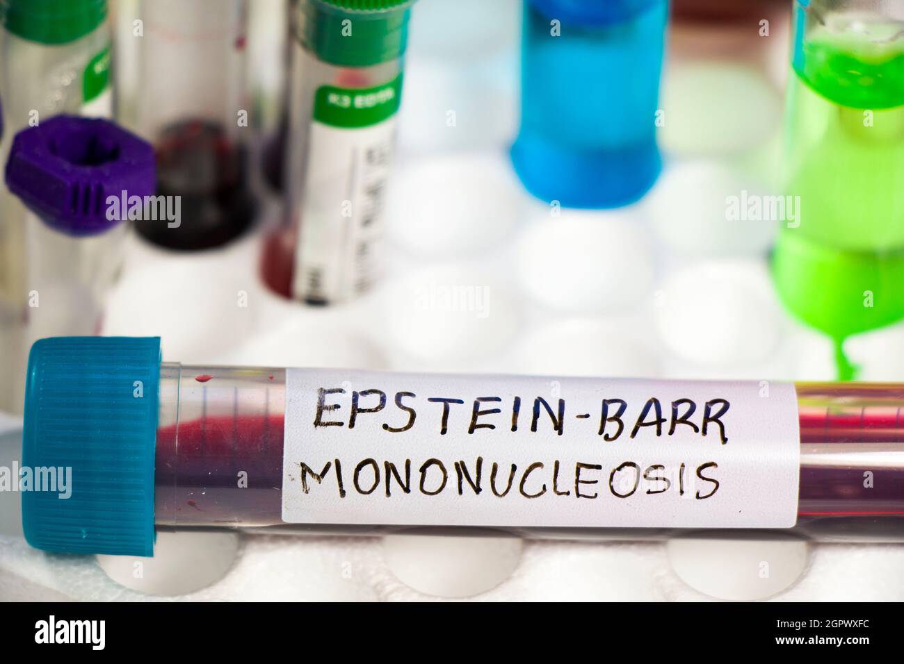 Mononucleosis blood High Resolution Stock Photography and Images - Alamy
