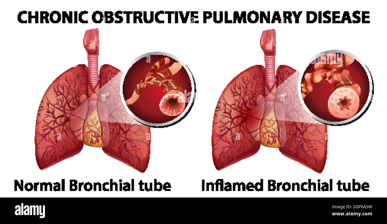 Chronic obstructive pulmonary disease Stock Vector Image & Art - Alamy