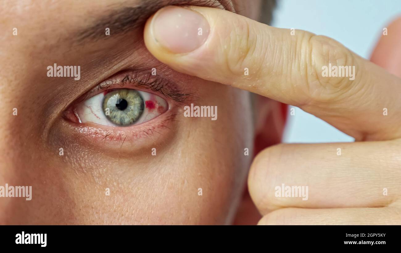 close-up of a man's sore eye, stretched wide with fingers Stock Photo ...