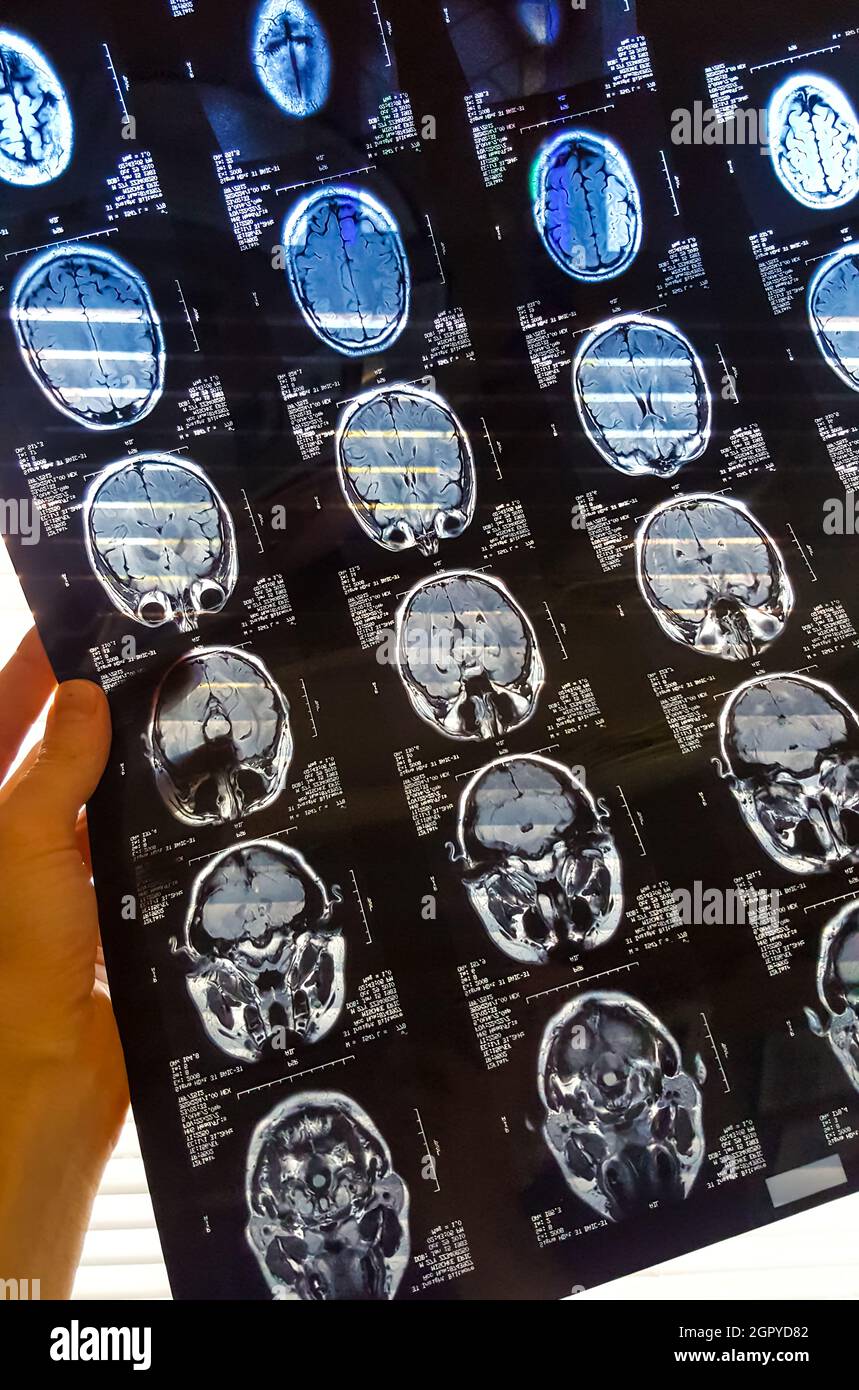 Close up of the mri scan of the human brain hi-res stock photography ...