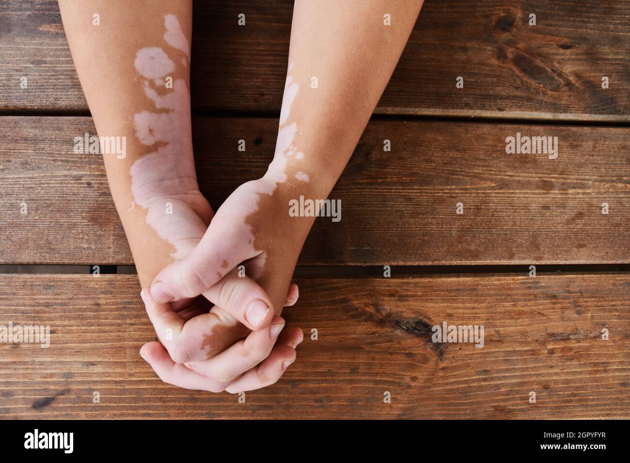 Skin affected by vitiligo hi-res stock photography and images - Alamy