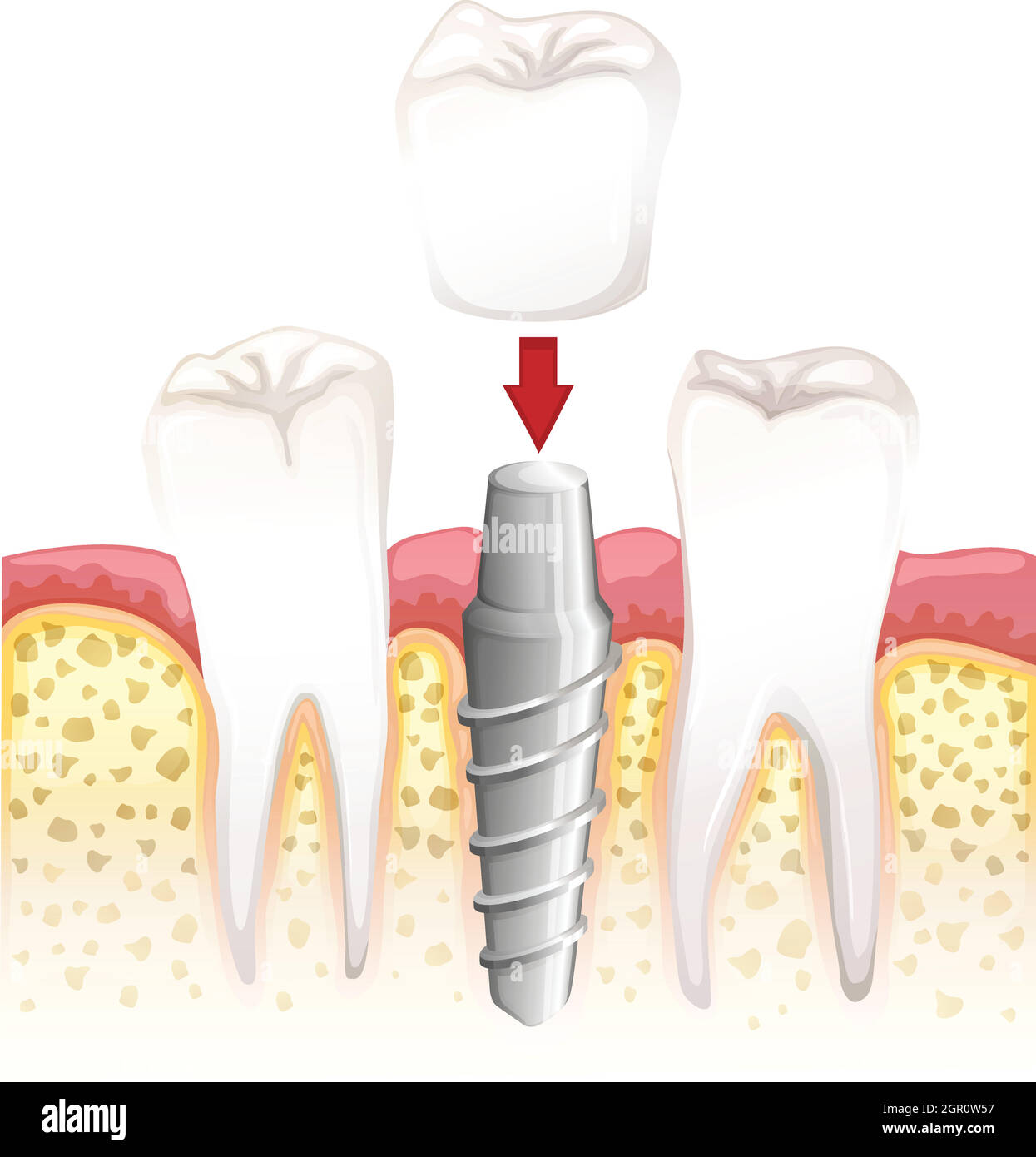 Replacement procedure Stock Vector Images - Alamy