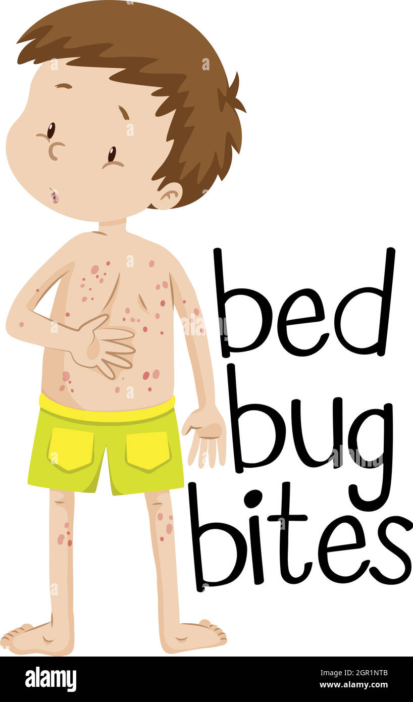 Boy having bed bug bites Stock Vector Image & Art - Alamy