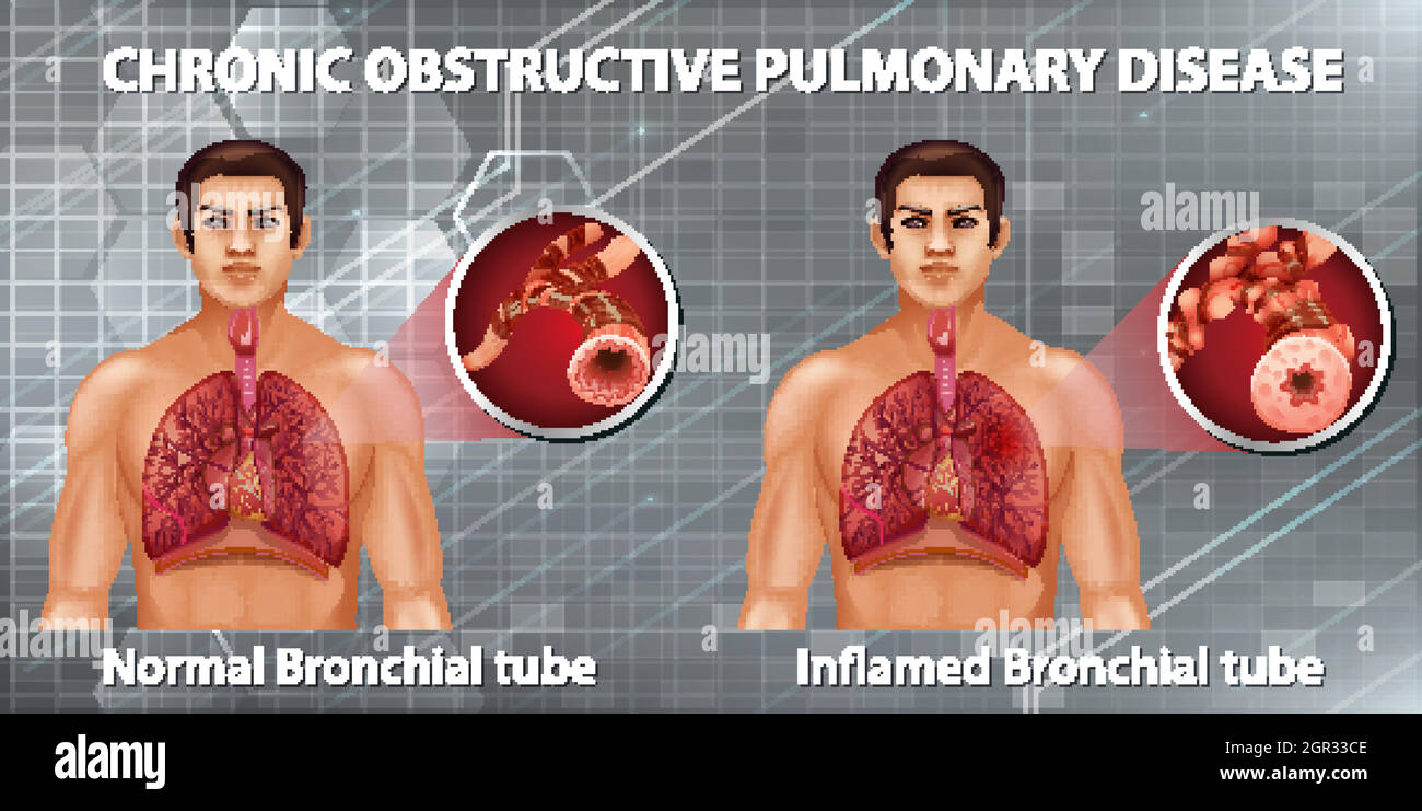 Copd graphic Stock Vector Images - Alamy