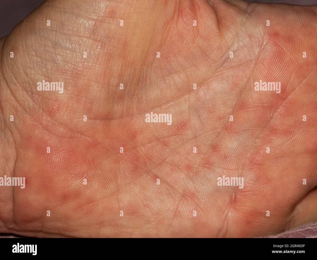 Scarlet fever rash hi-res stock photography and images - Alamy