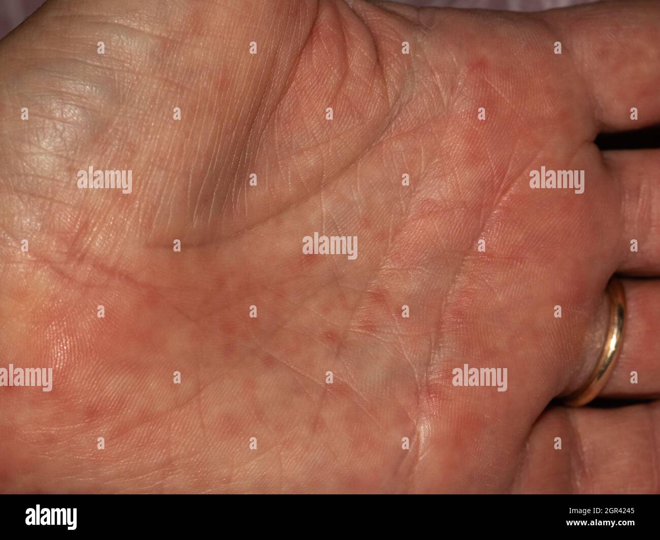 Scarlet Fever Rash High Resolution Stock Photography and Images - Alamy
