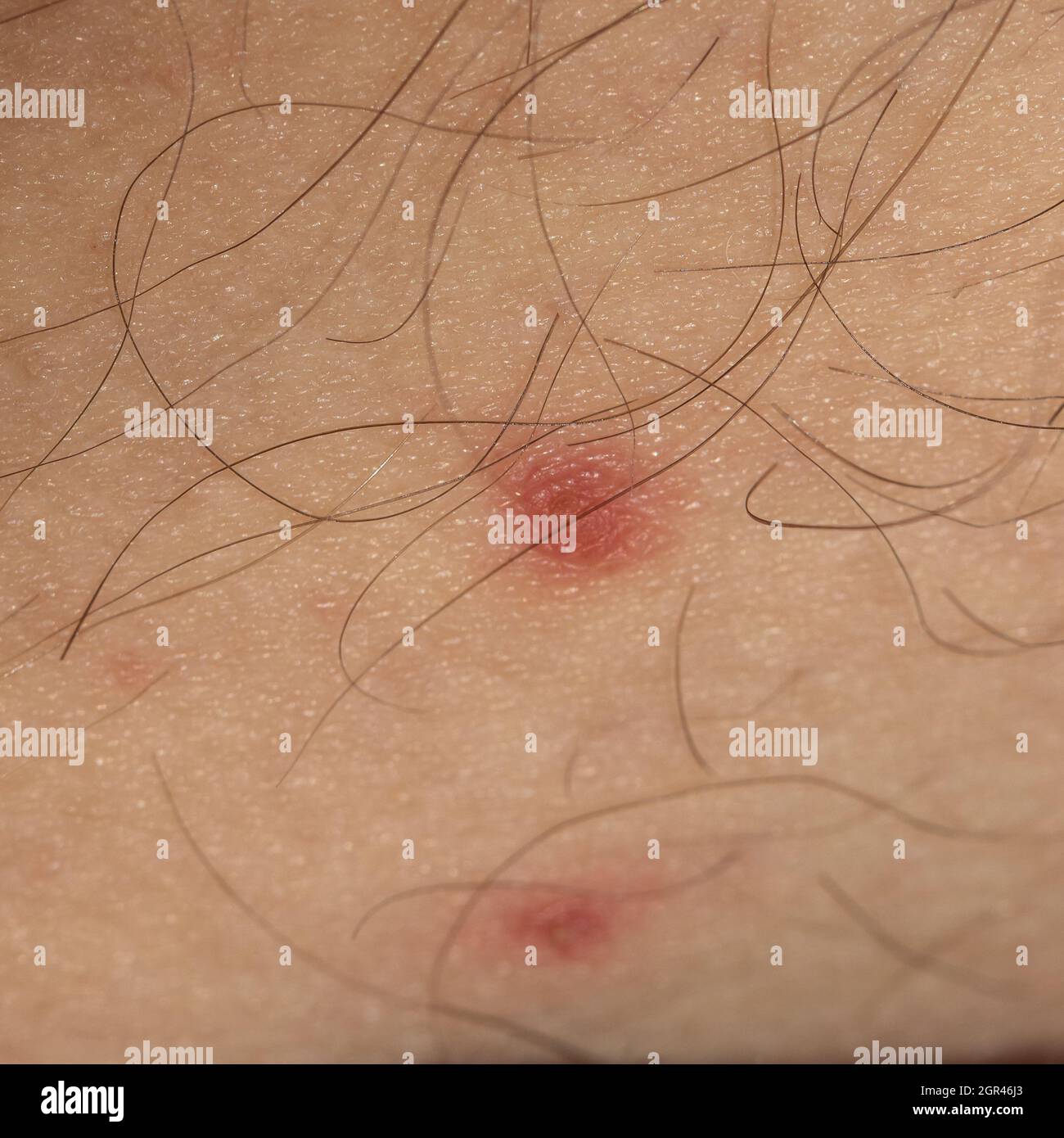 Scarlet fever rash hi-res stock photography and images - Alamy