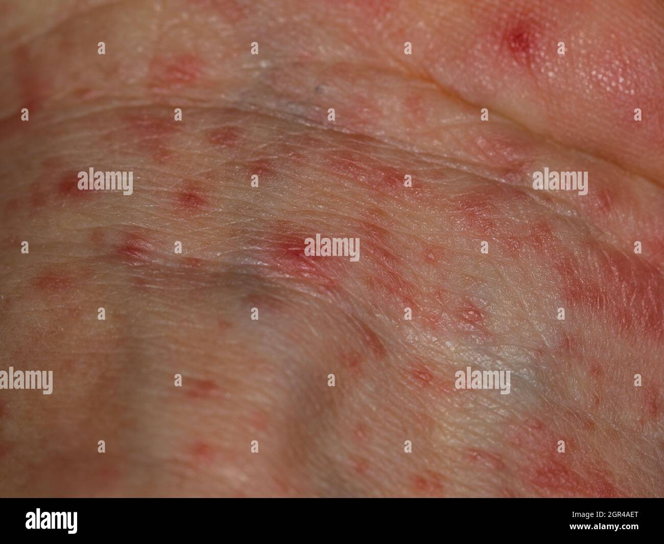 Scarlet fever rash hi-res stock photography and images - Alamy