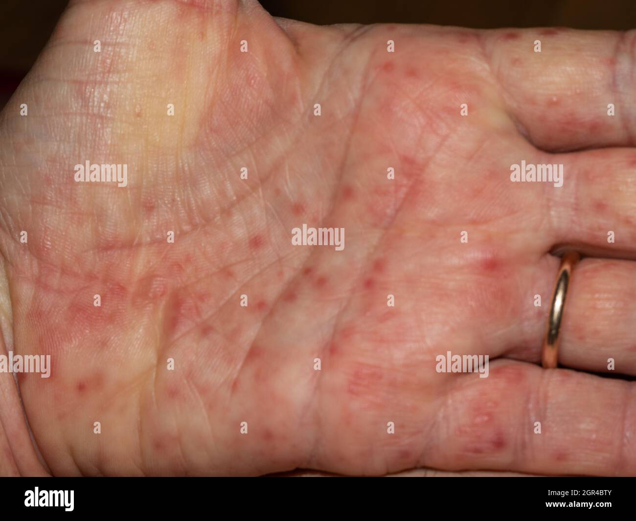 Scarlet fever rash hi-res stock photography and images - Alamy