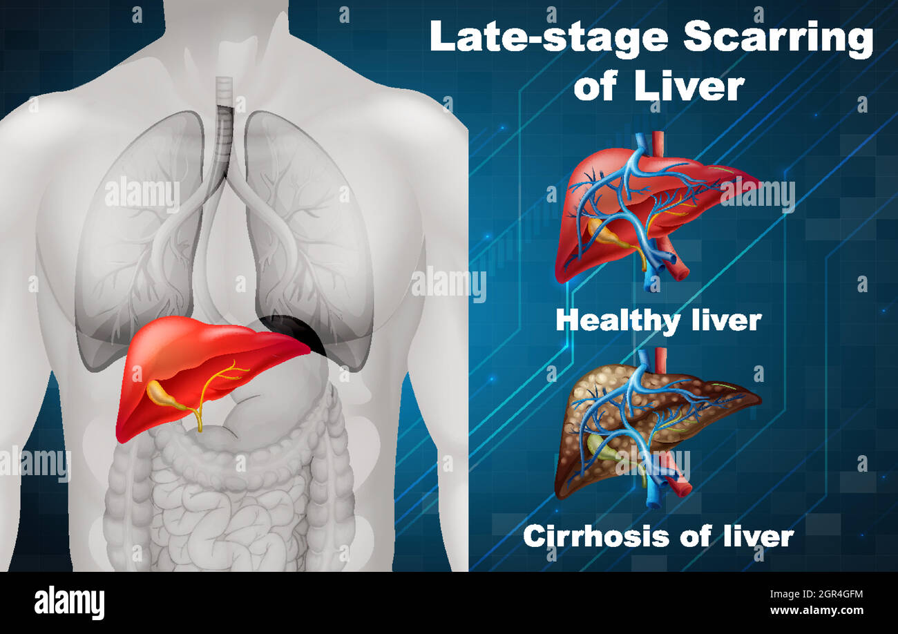 Late-stage scarring of liver Stock Vector Image & Art - Alamy