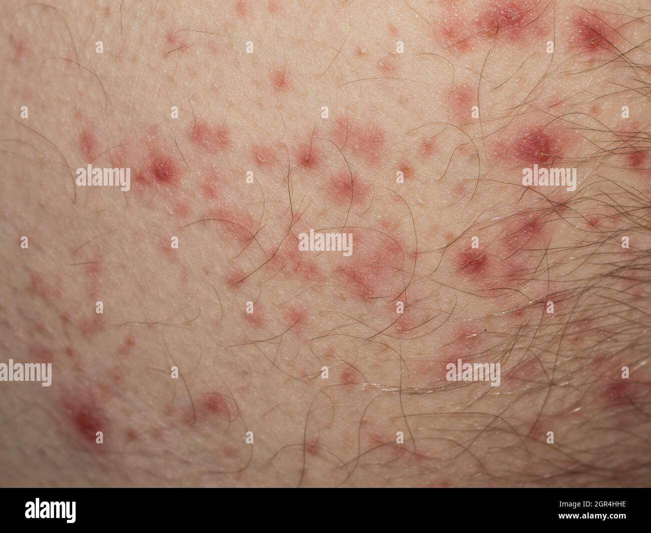 Skin rash and fever hi-res stock photography and images - Alamy