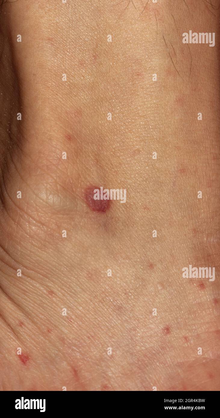Scarlet fever skin hi-res stock photography and images - Alamy
