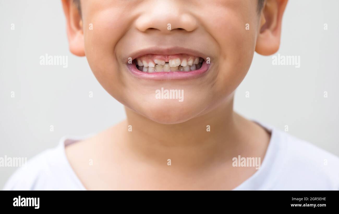 Upper jaw of the face hi-res stock photography and images - Alamy