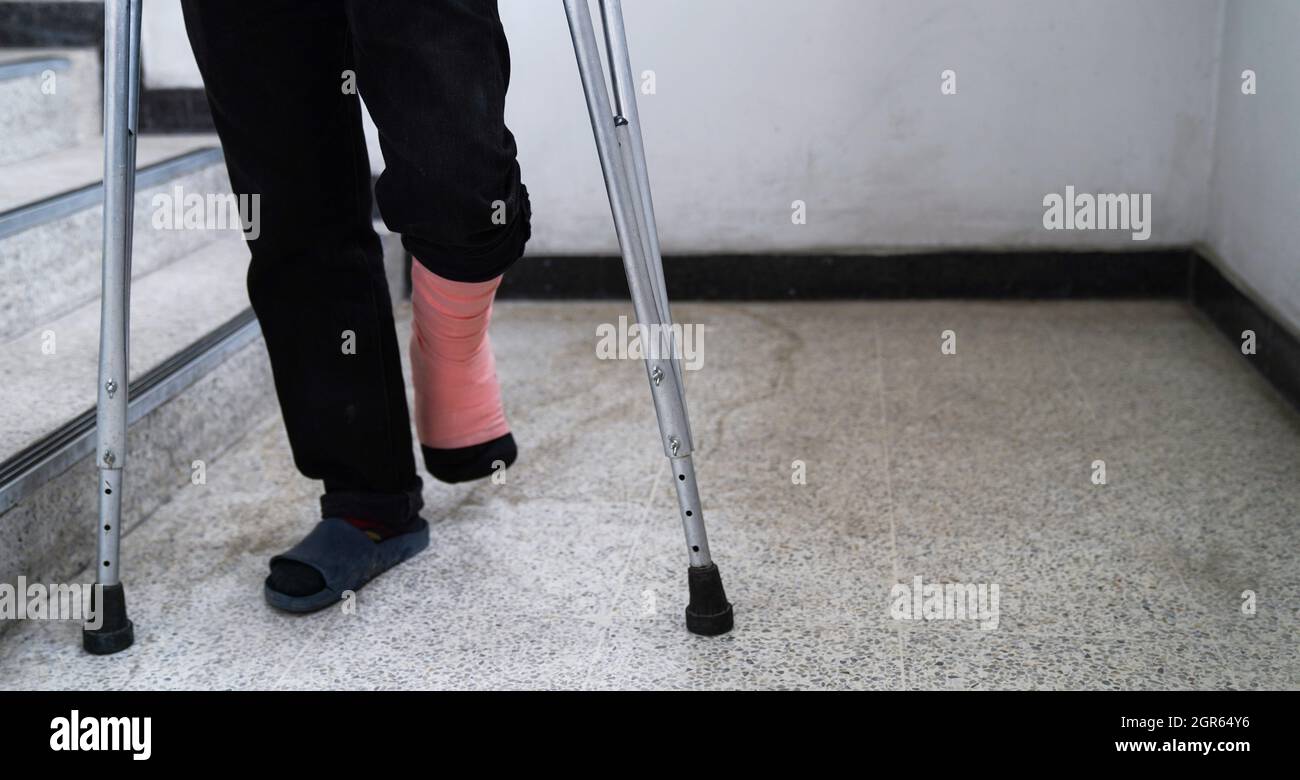 Broken limb hi-res stock photography and images - Alamy