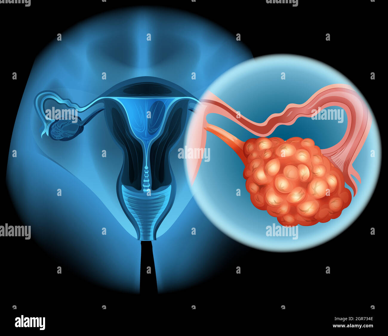 Ovarian cancer in human Stock Vector Image & Art - Alamy