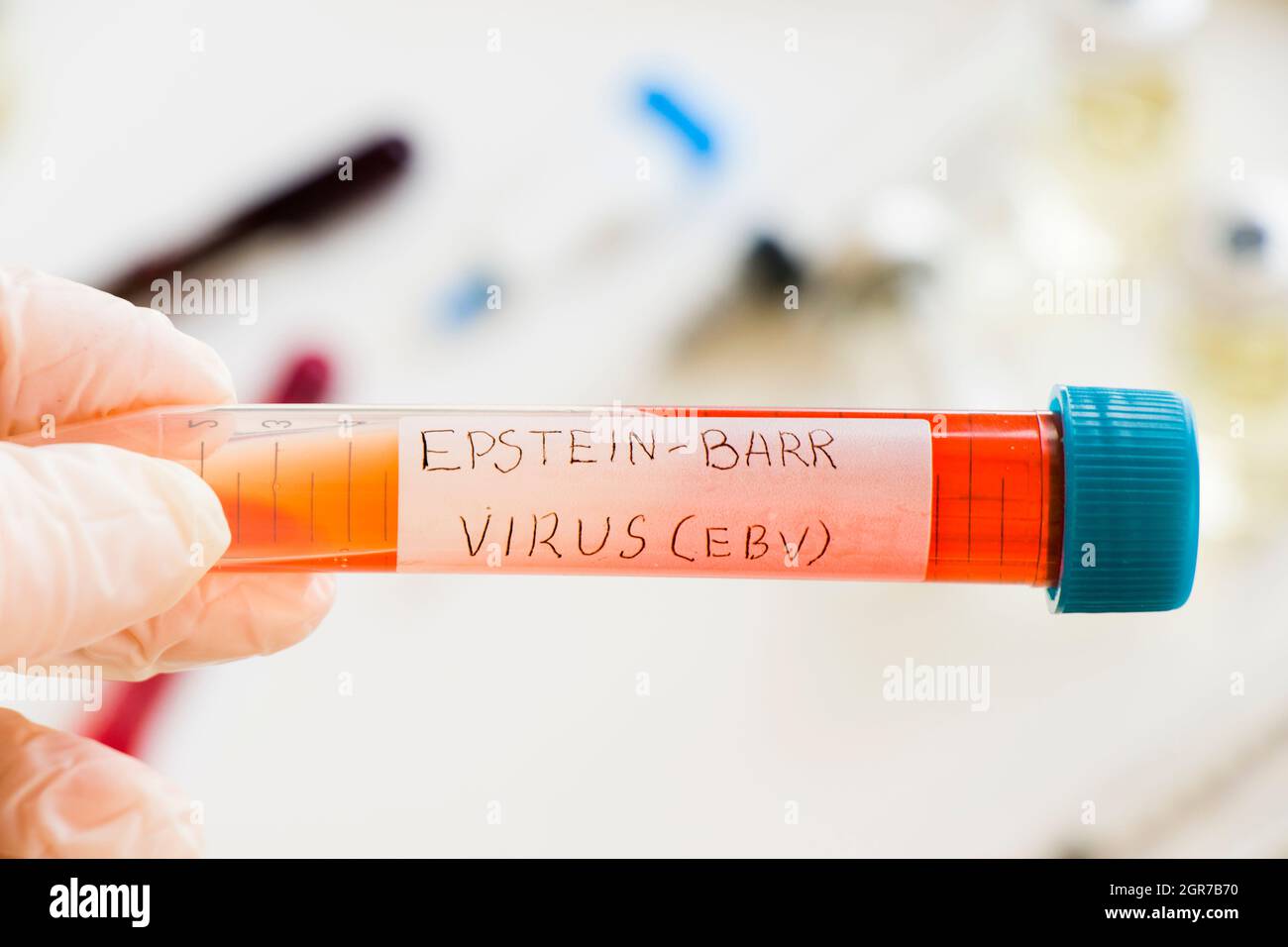 Epstein barr virus infection hi-res stock photography and images - Alamy