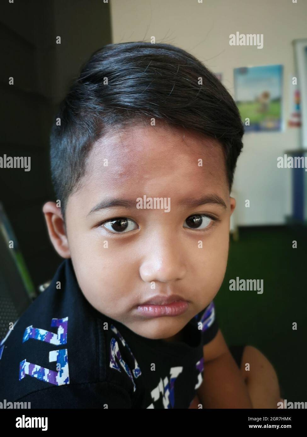 Urticaria black skin hi-res stock photography and images - Alamy