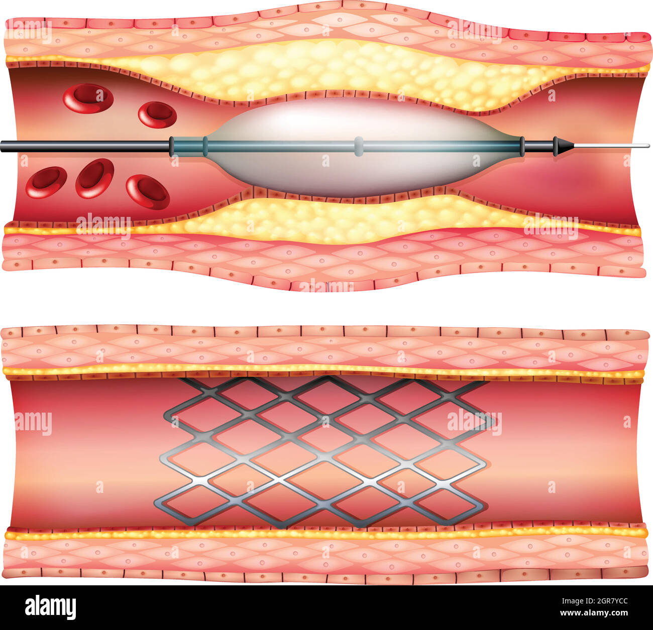 Coronary stent hi-res stock photography and images - Alamy