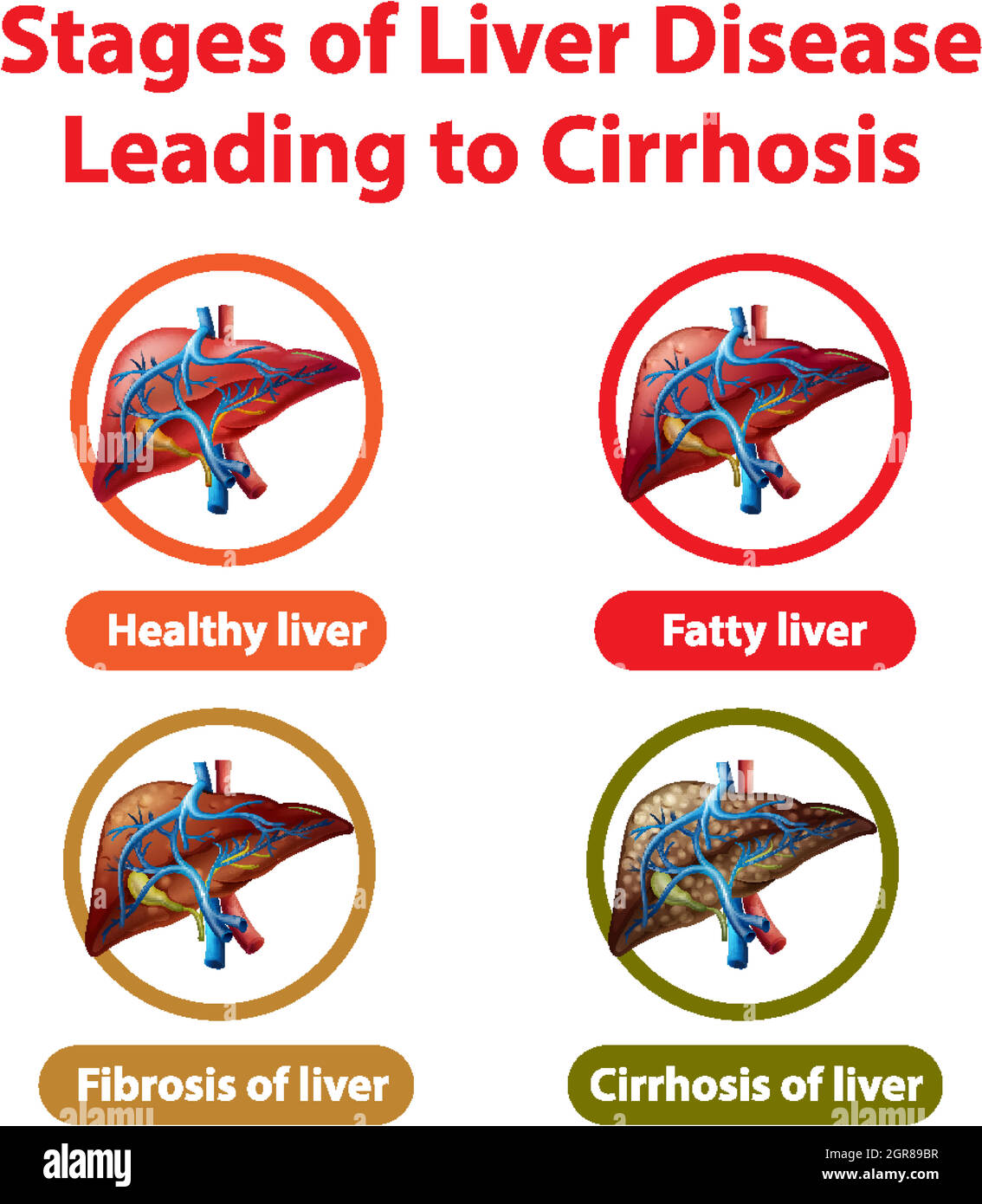 Chronic Liver Disease Stock Vector Images - Alamy