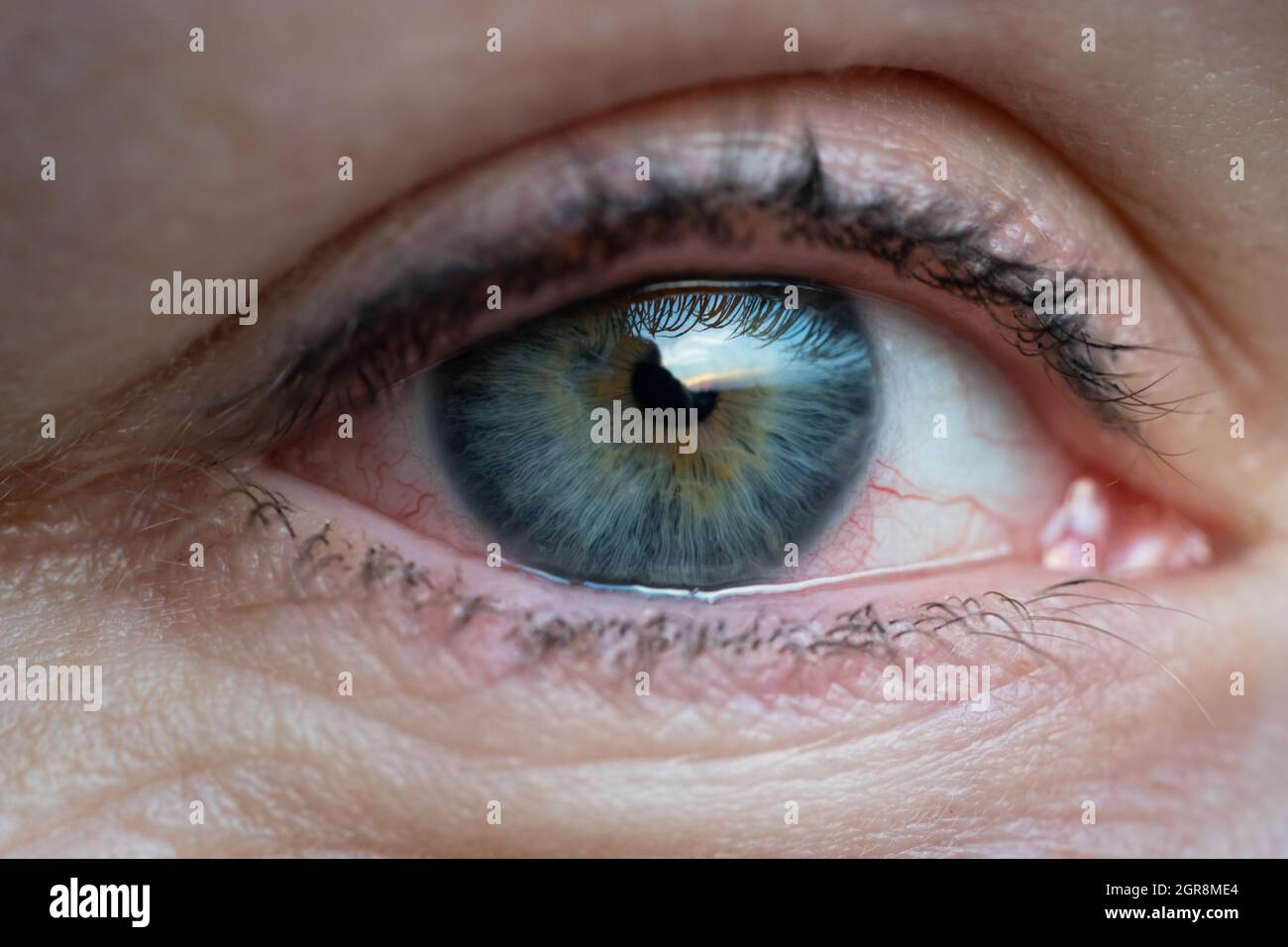Close up human eye conjunctivitis hi-res stock photography and images ...