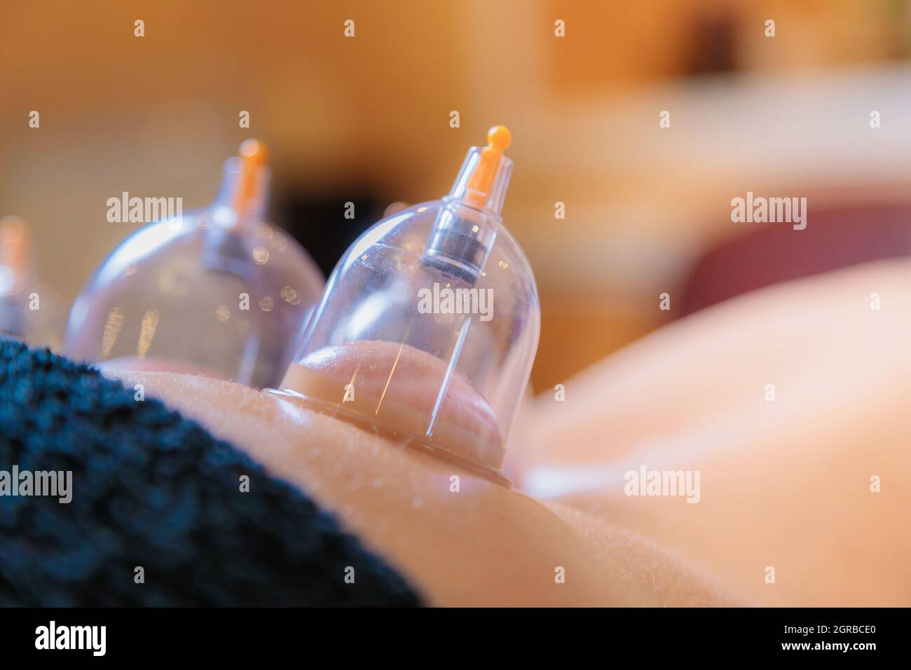 Hijama treatment hi-res stock photography and images - Alamy