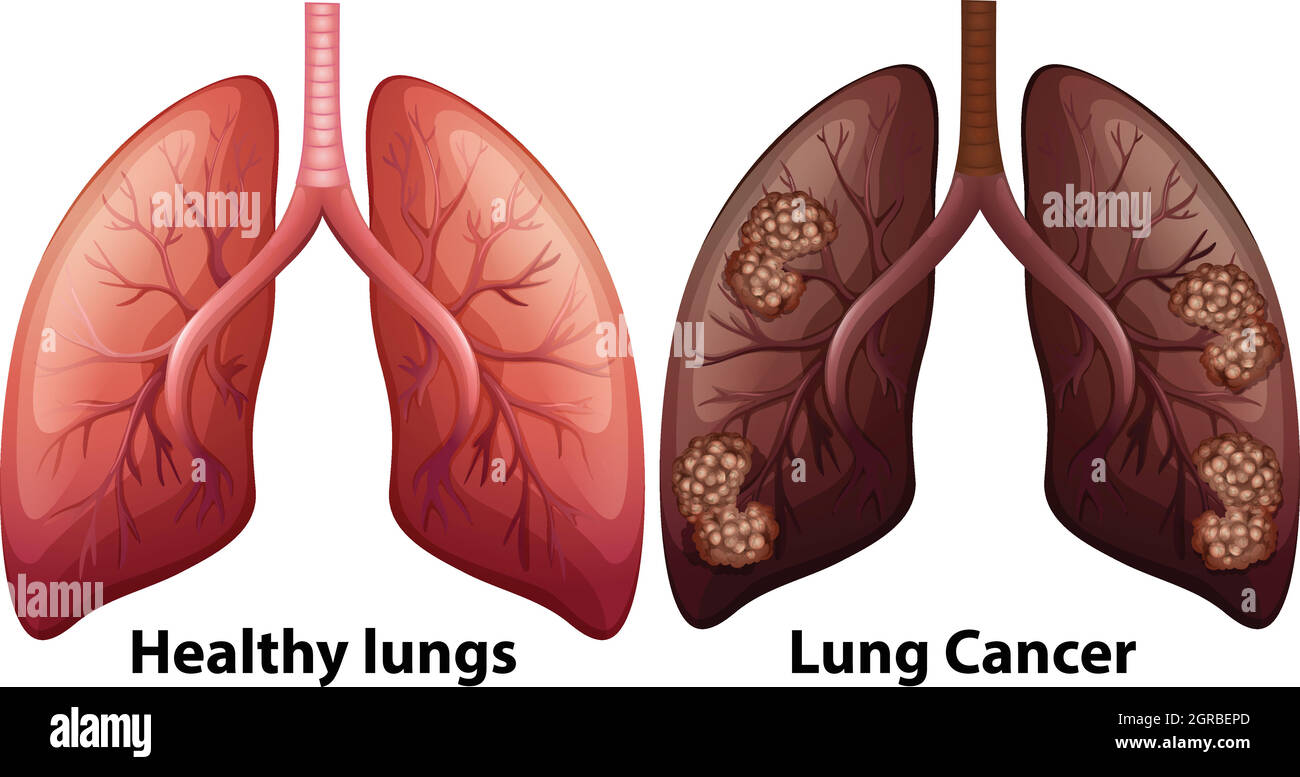 Human Anatomy of Lung Condition Stock Vector Image & Art - Alamy