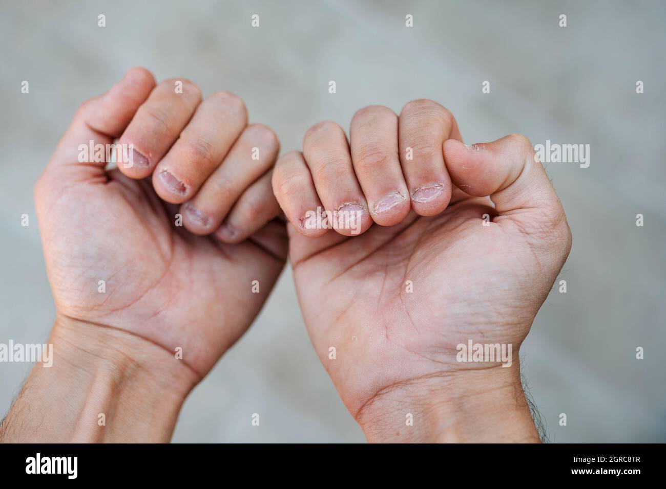 Bitten finger nails hi-res stock photography and images - Alamy