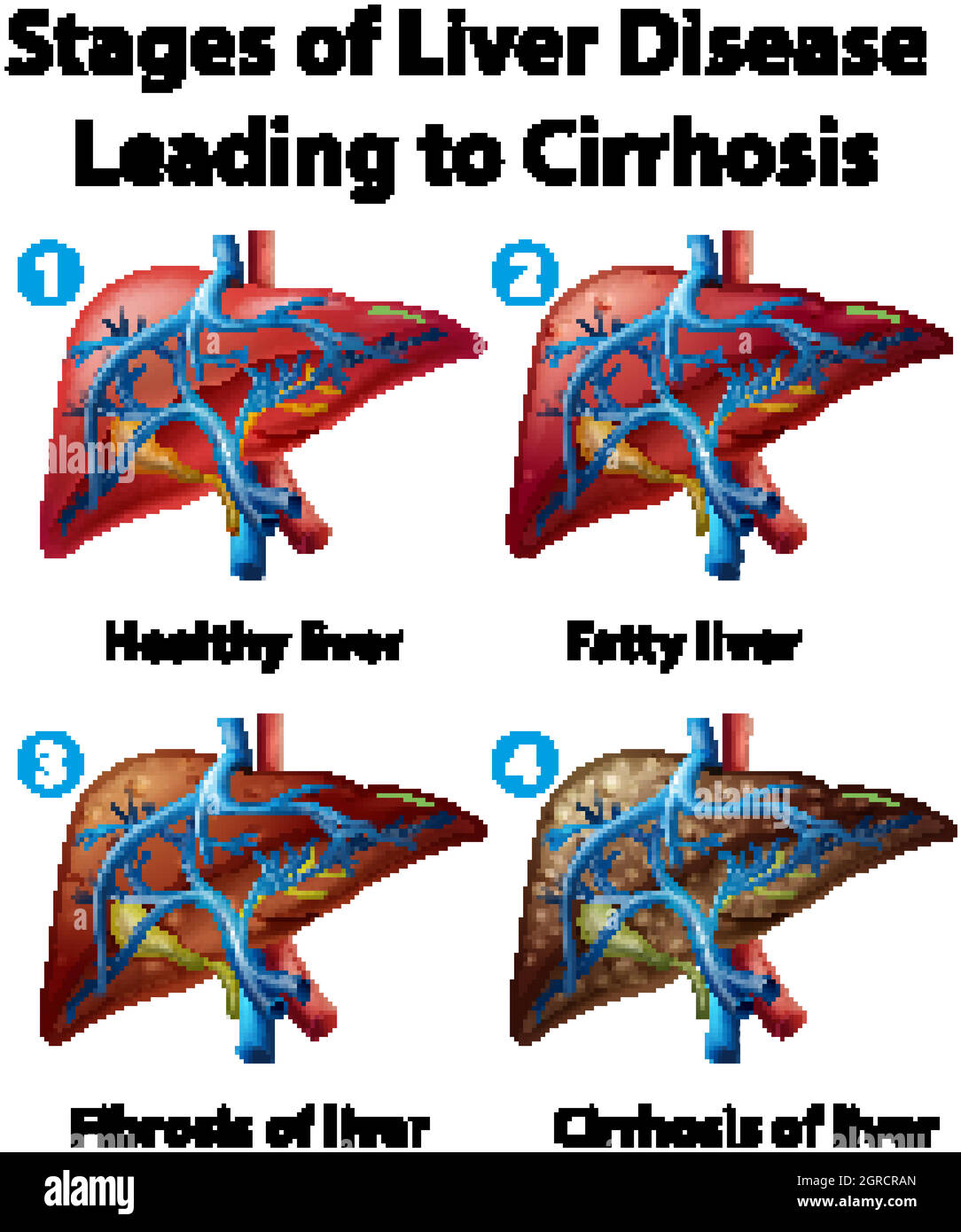 Stages of liver disease leading to Cirrhosis Stock Vector Image & Art ...