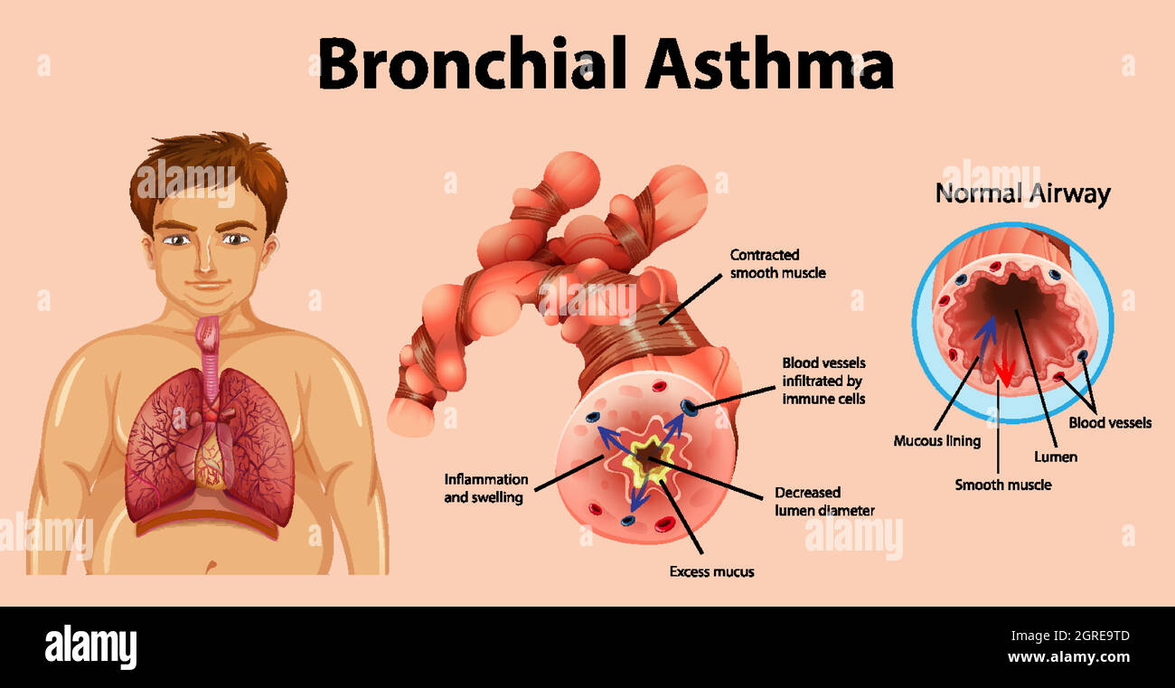 Asthma inflamed bronchial tube Stock Vector Image & Art - Alamy