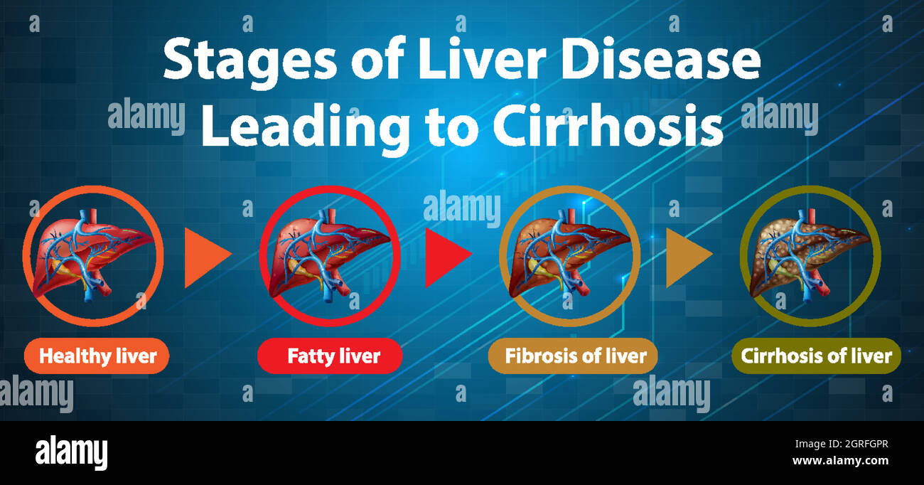 Stages of liver disease leading to Cirrhosis Stock Vector Image & Art ...