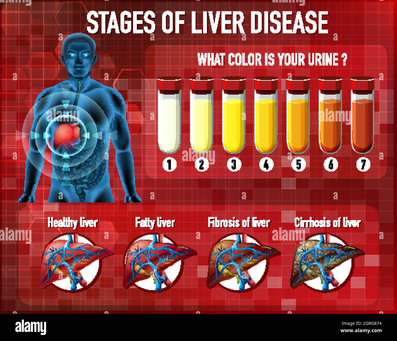 Stages of liver disease Stock Vector Image & Art - Alamy