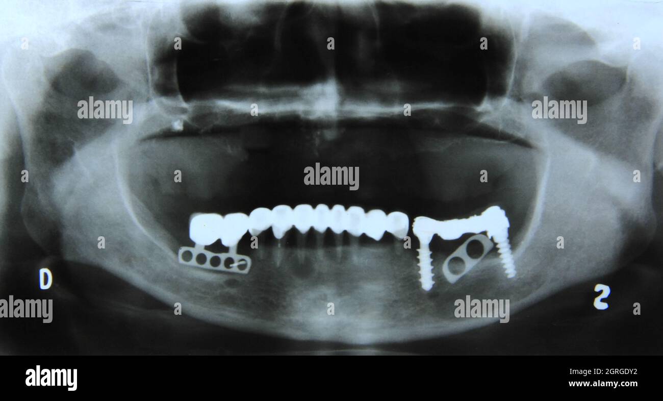 X-ray of the mandible and denture Stock Photo - Alamy