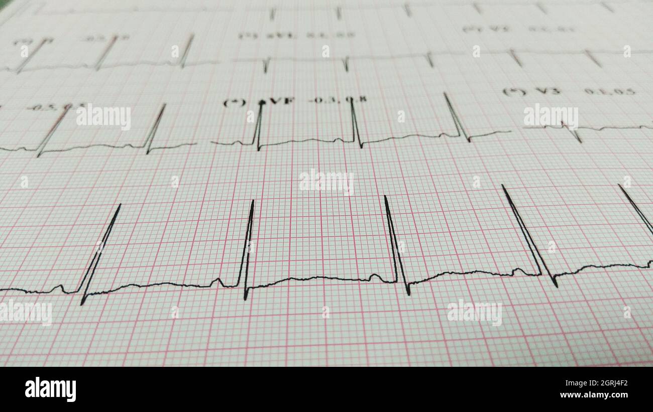 Ecg trace hi-res stock photography and images - Alamy