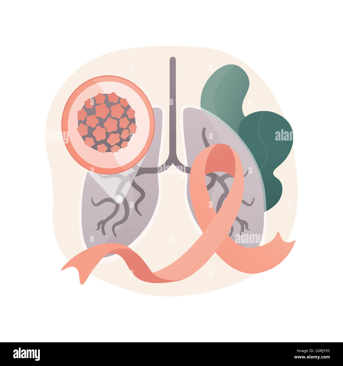 Lung cancer abstract concept vector illustration Stock Vector Image ...