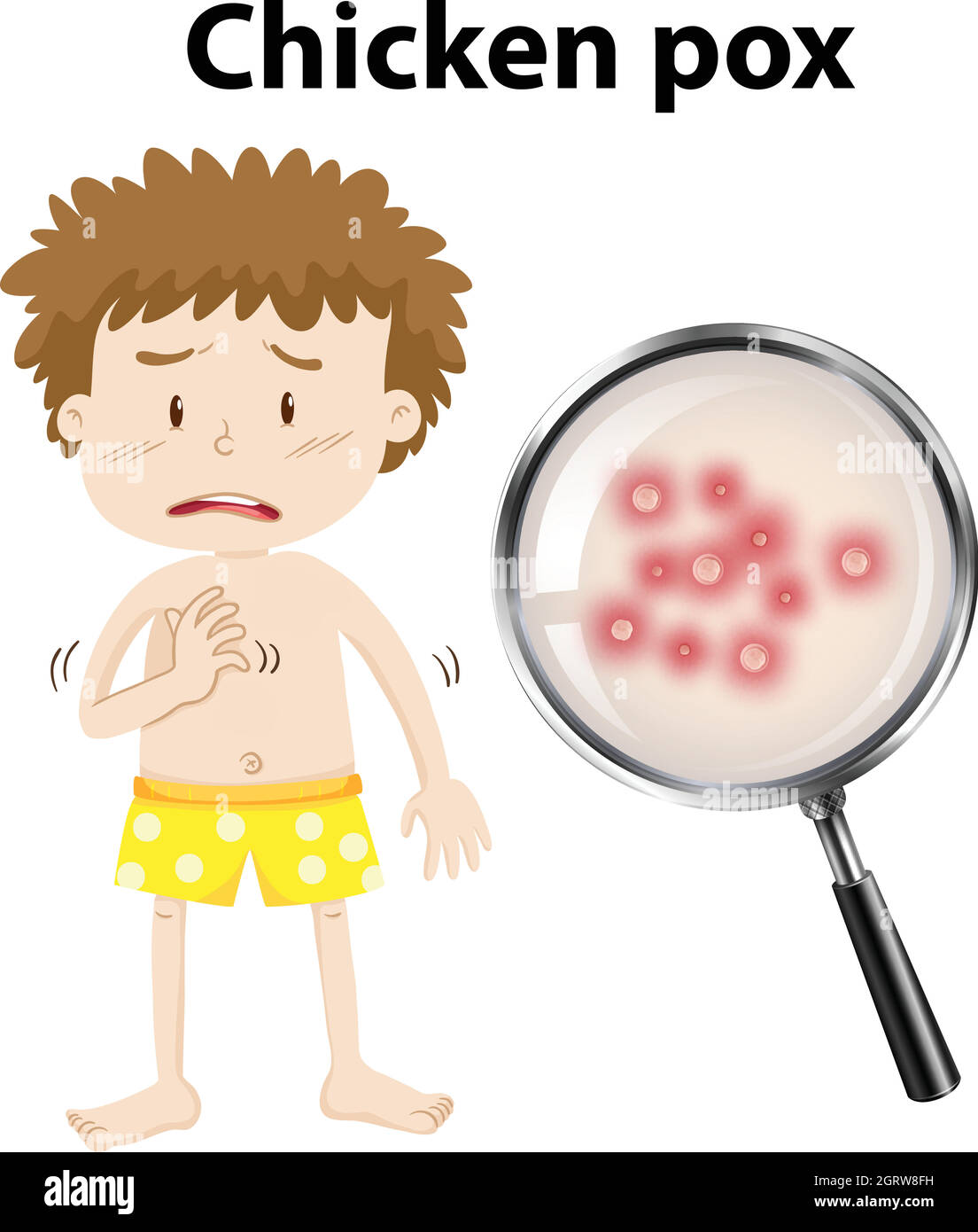A young kid with chicken pox Stock Vector Image & Art - Alamy
