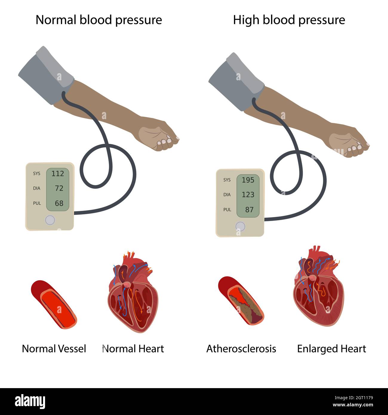 Comparison normal heart coronary hi-res stock photography and images ...
