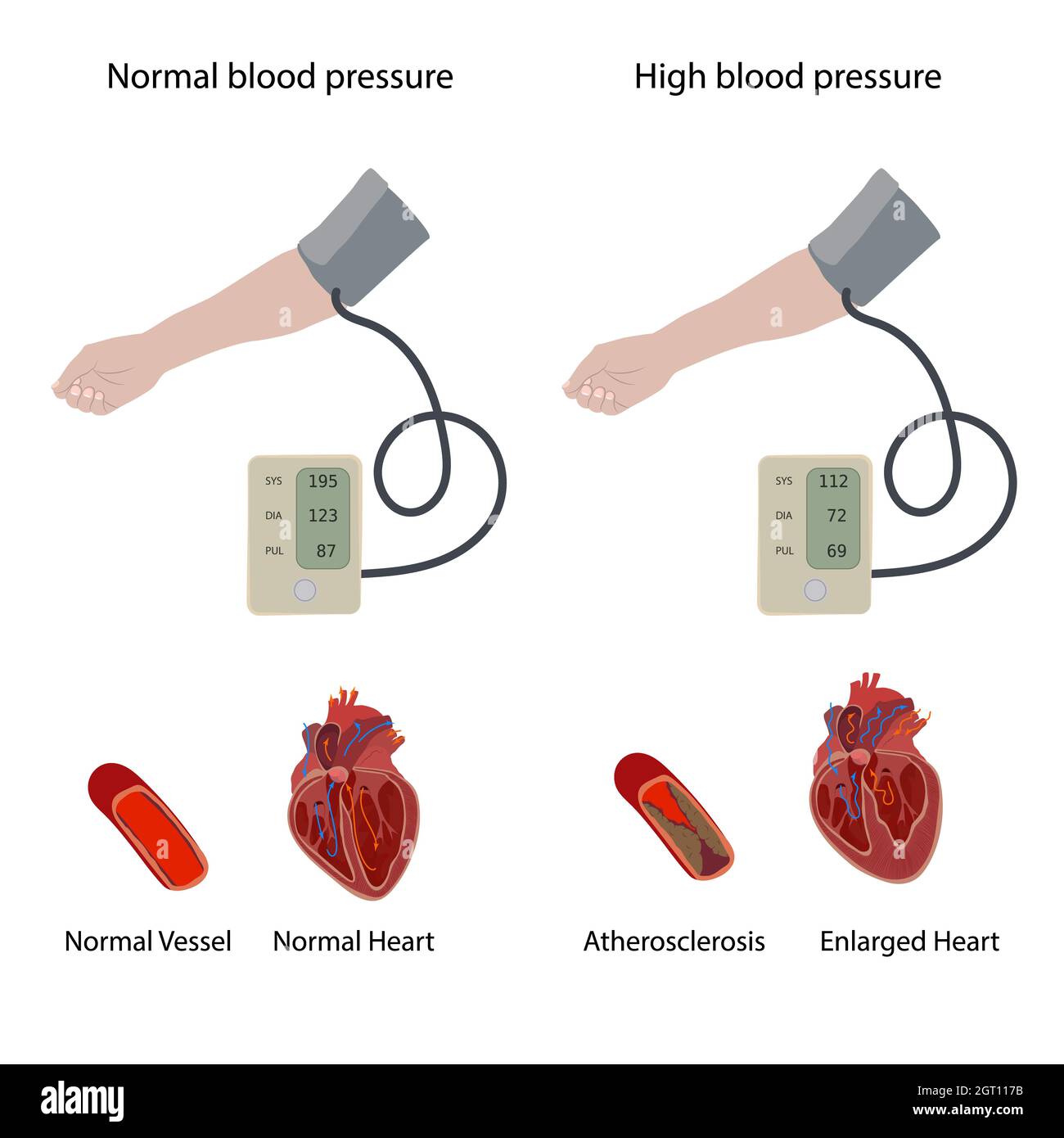 Hypertensive heart disease, illustration Stock Photo - Alamy