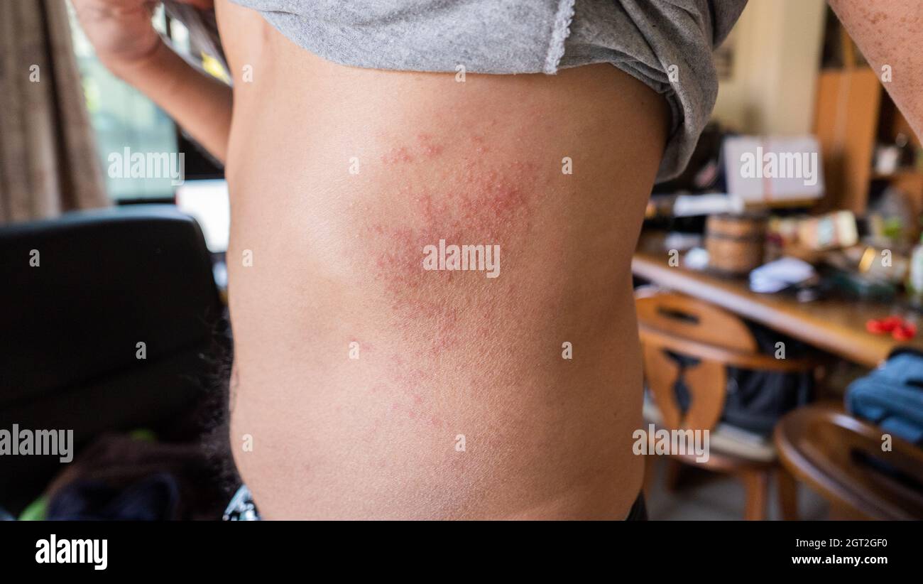 Asian skin rash hi-res stock photography and images - Alamy