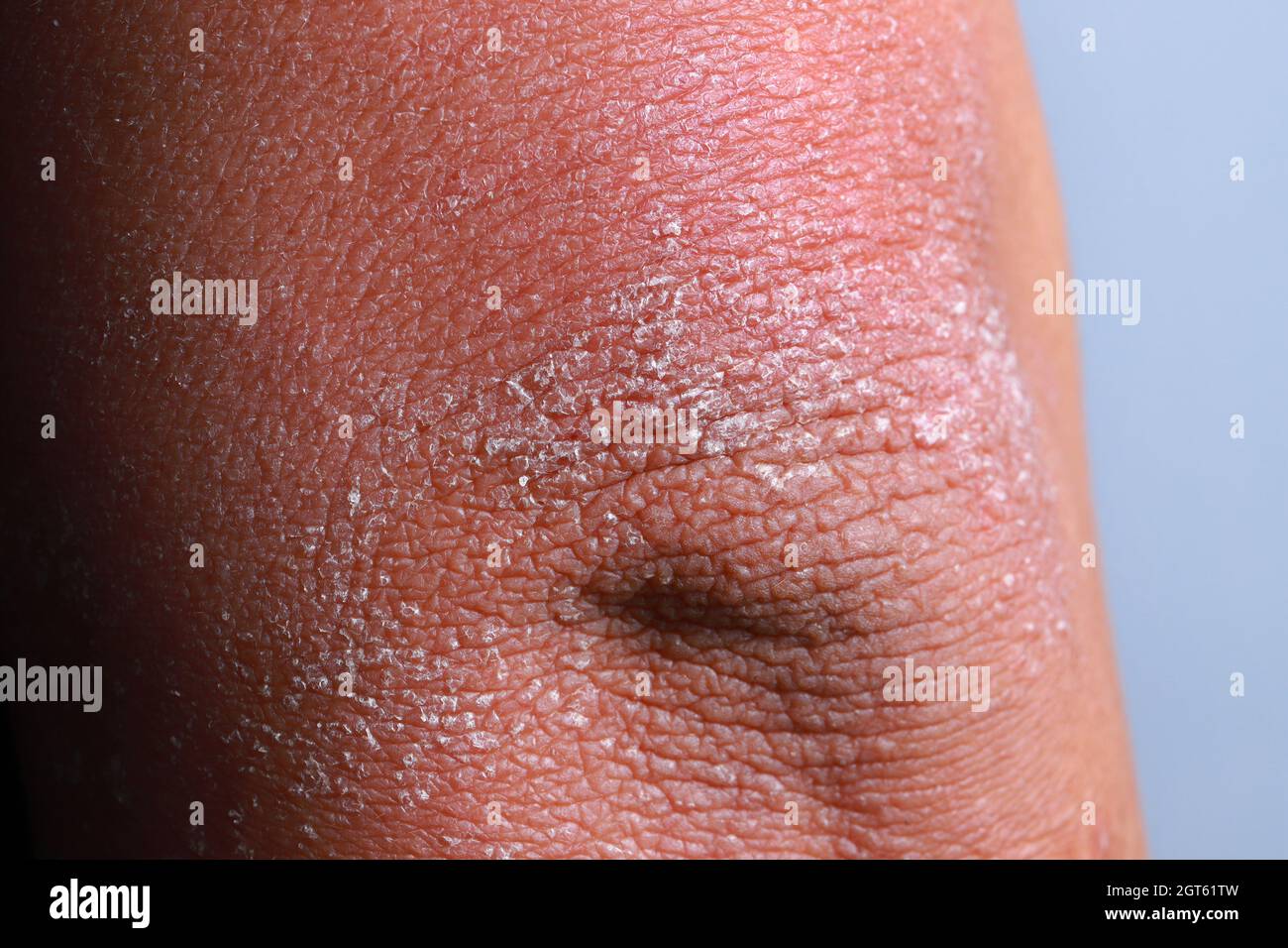 Skin rash on elbow hi-res stock photography and images - Alamy