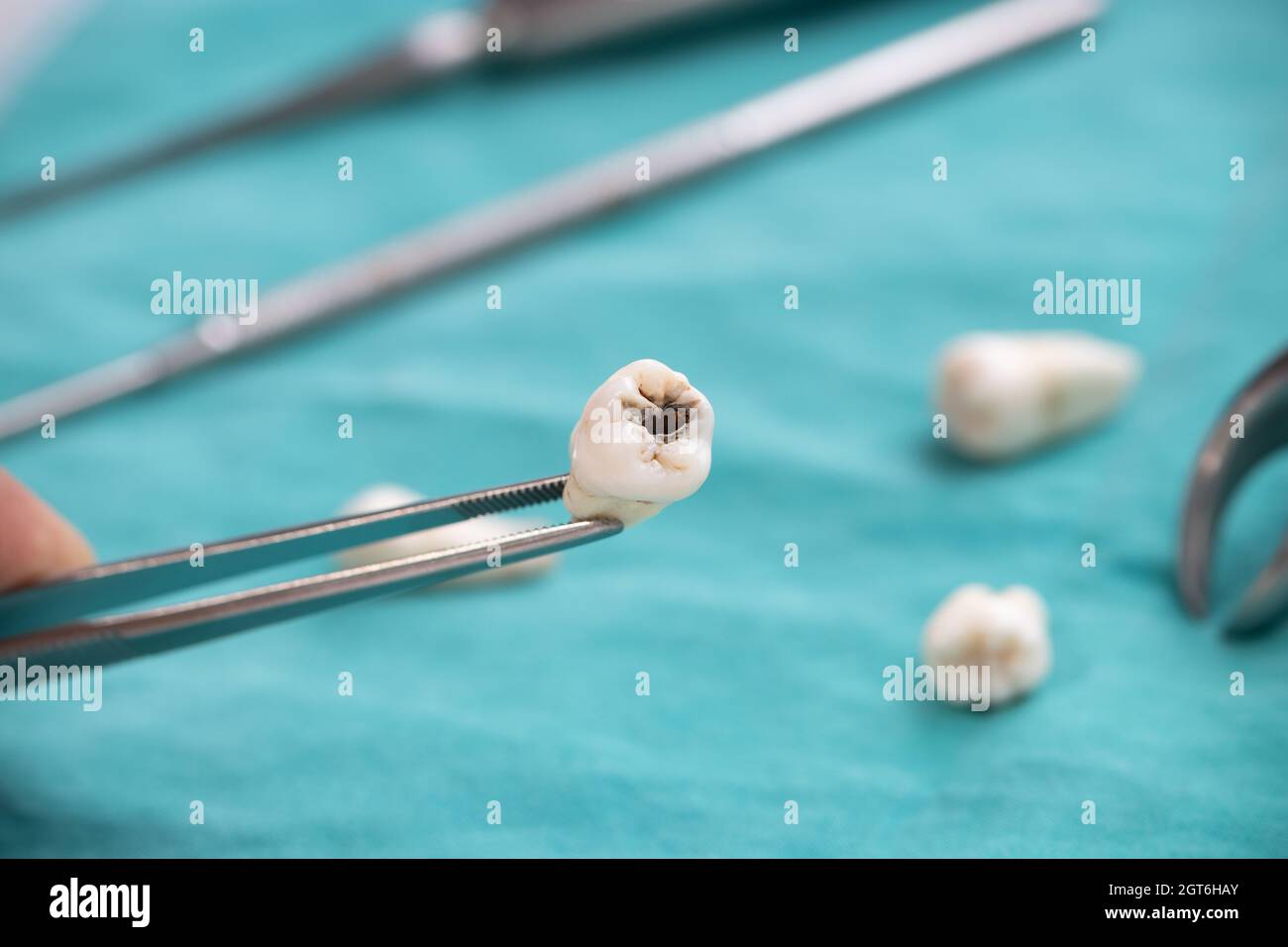 Tooth extraction tools hi-res stock photography and images - Alamy